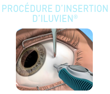 Vidéo d'administration d'Iluvien